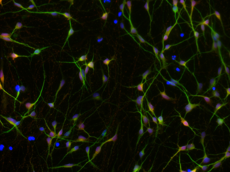 One mutation, many challenges: Unraveling the mystery behind fragile X ...