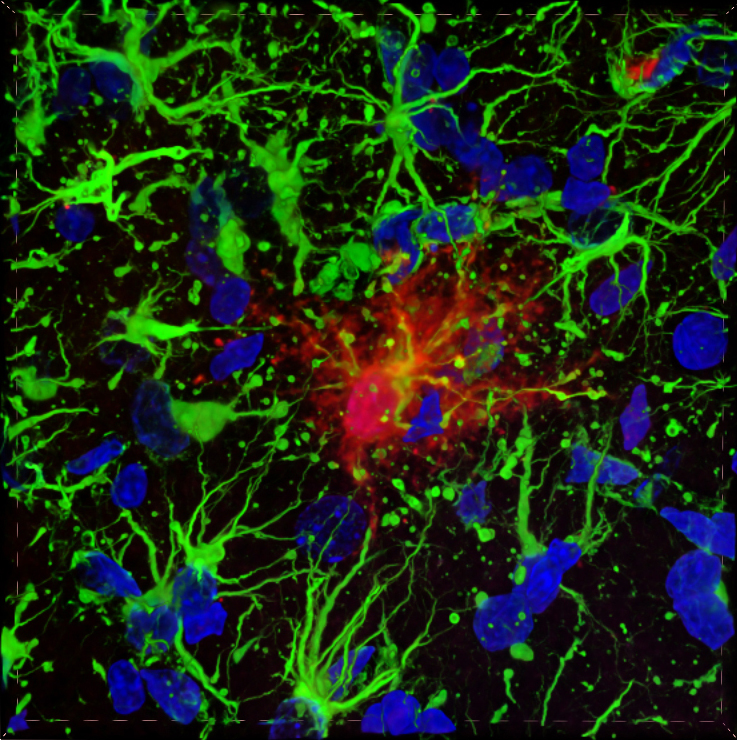 Alexander disease: A lifetime’s work in the hope of saving lives ...