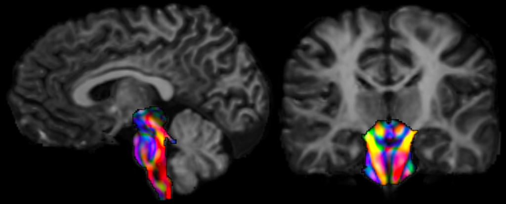 Sensory responses in autistic children are linked to a small under ...