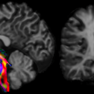 Brain Imaging News – Waisman Center – UW–Madison