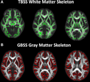 Study Reveals Differences in Brain Structure for Older Autistic Adults ...