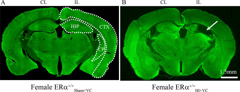 Estrogen receptor alpha mediates protection against hypoxic ischemic ...